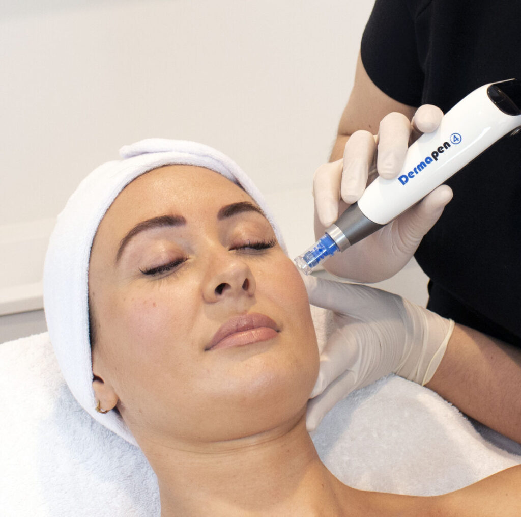 Skin Needling - Dermapen - Chantal Louise Skin Therapy